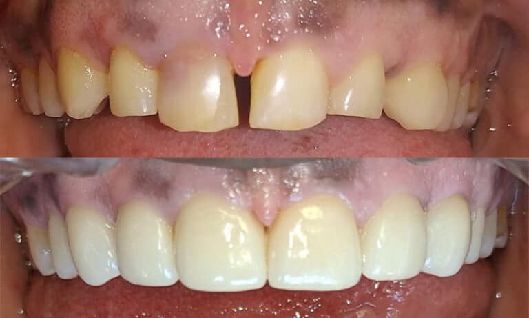 All About Ceramic Dental Crowns - Online Dental Care